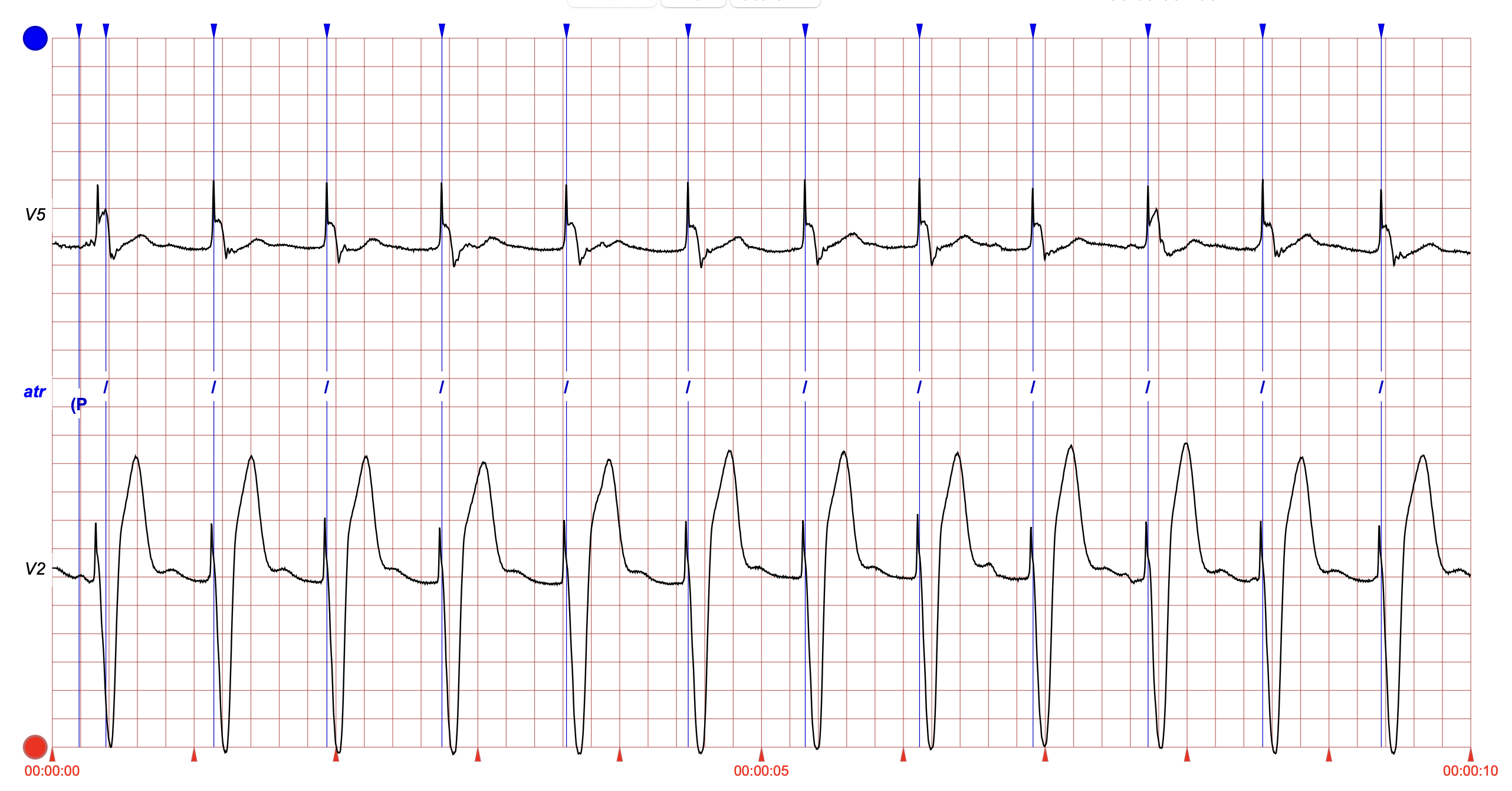 MIT-BIH Arrhythmia DB 공부