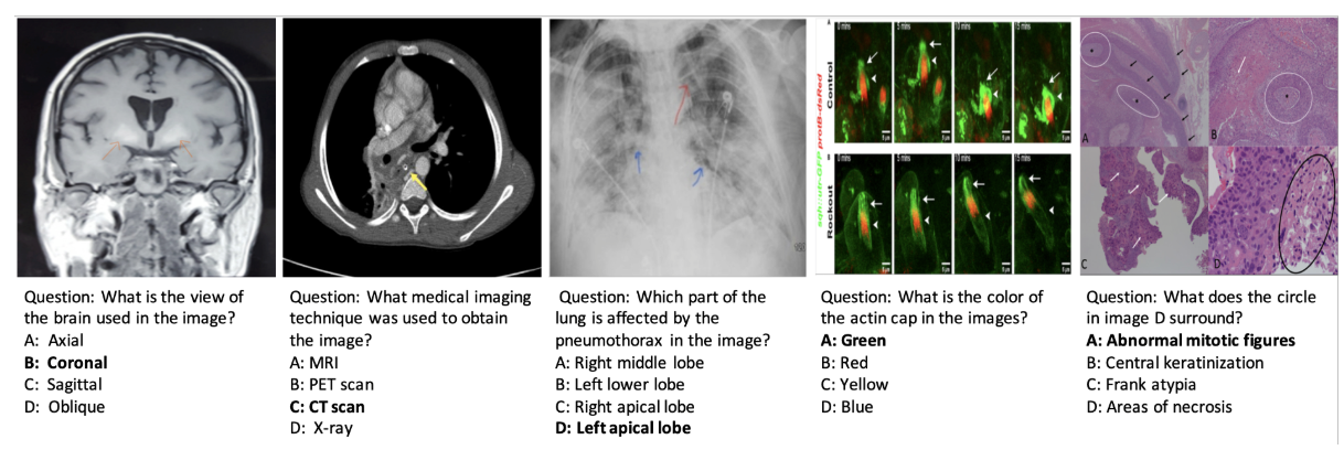 Survey of Medical VQA