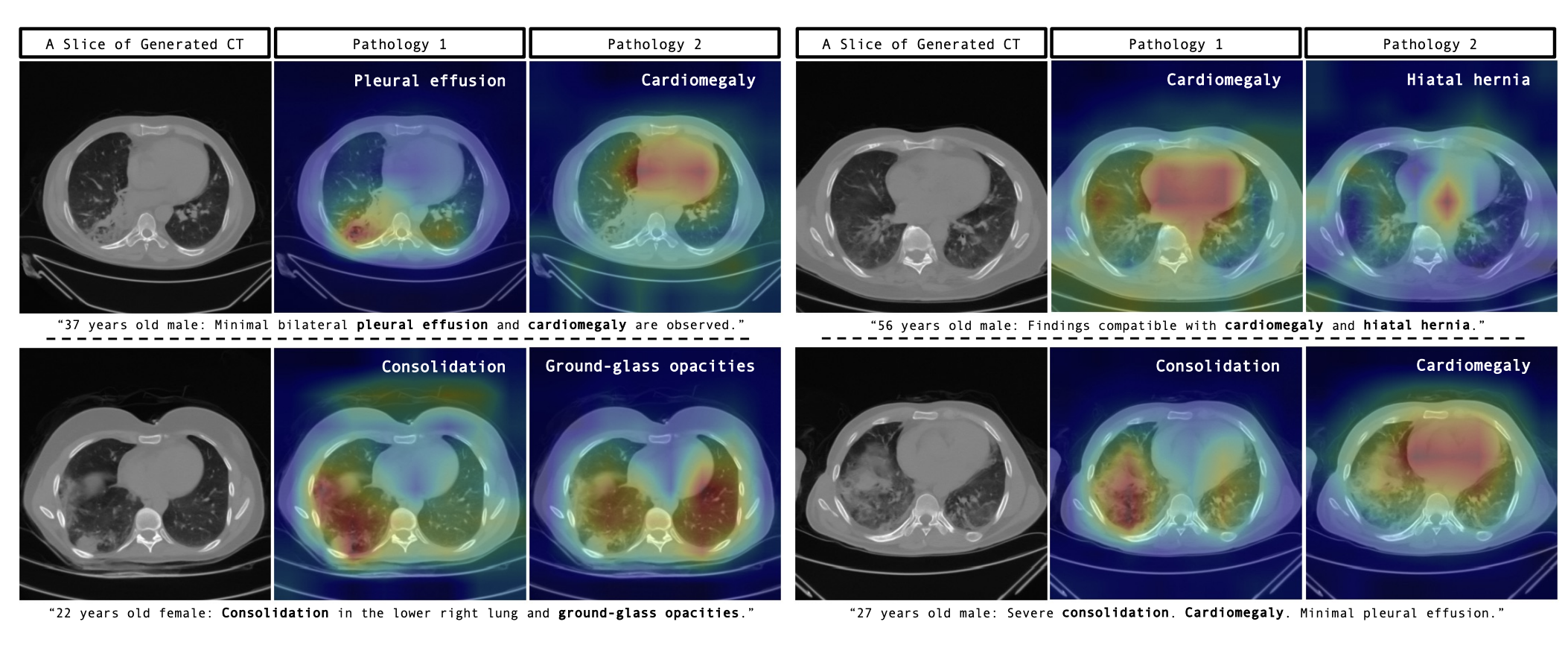 GenerateCT: Text-Conditional Generation of 3D Chest CT Volumes (ECCV 2024)